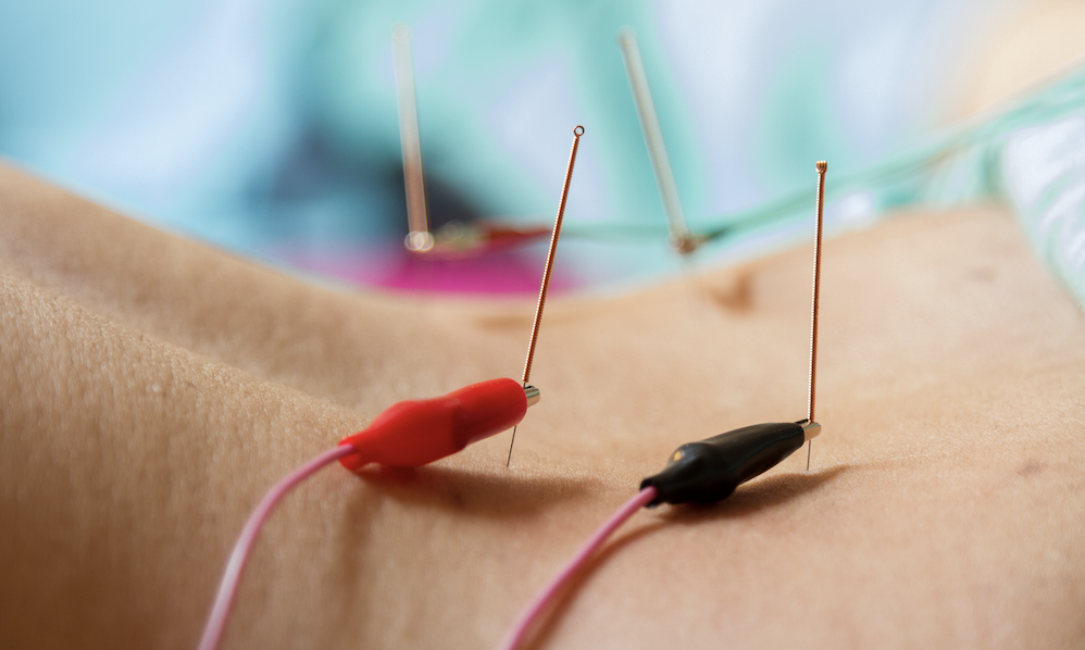 Acupuncture at Home for Sciatica: Target Acupuncture Points Using ...
