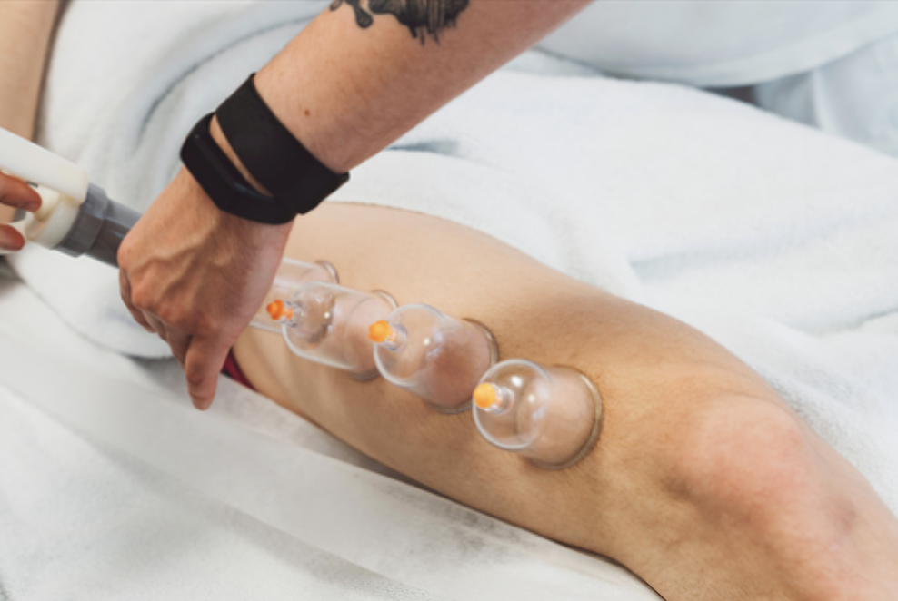 Acupuncture at Home for Sciatica: Target Acupuncture Points Using ...